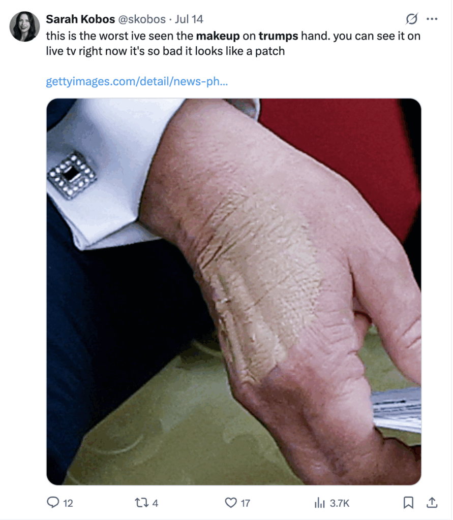 NEW: Experts Explain 'Concerning Marks' On Trump’s Hand